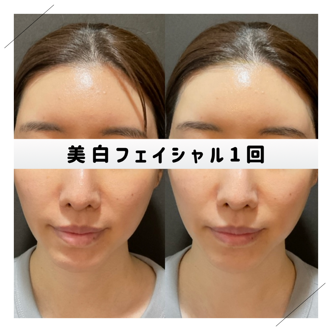 【サロンケア】夏の美白ケアはこのメニュー！ – BEBEAURA Store